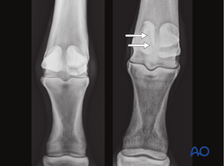 Sesamoid Fractures In Horse: Understanding Diagnosis, Treatment, and ...